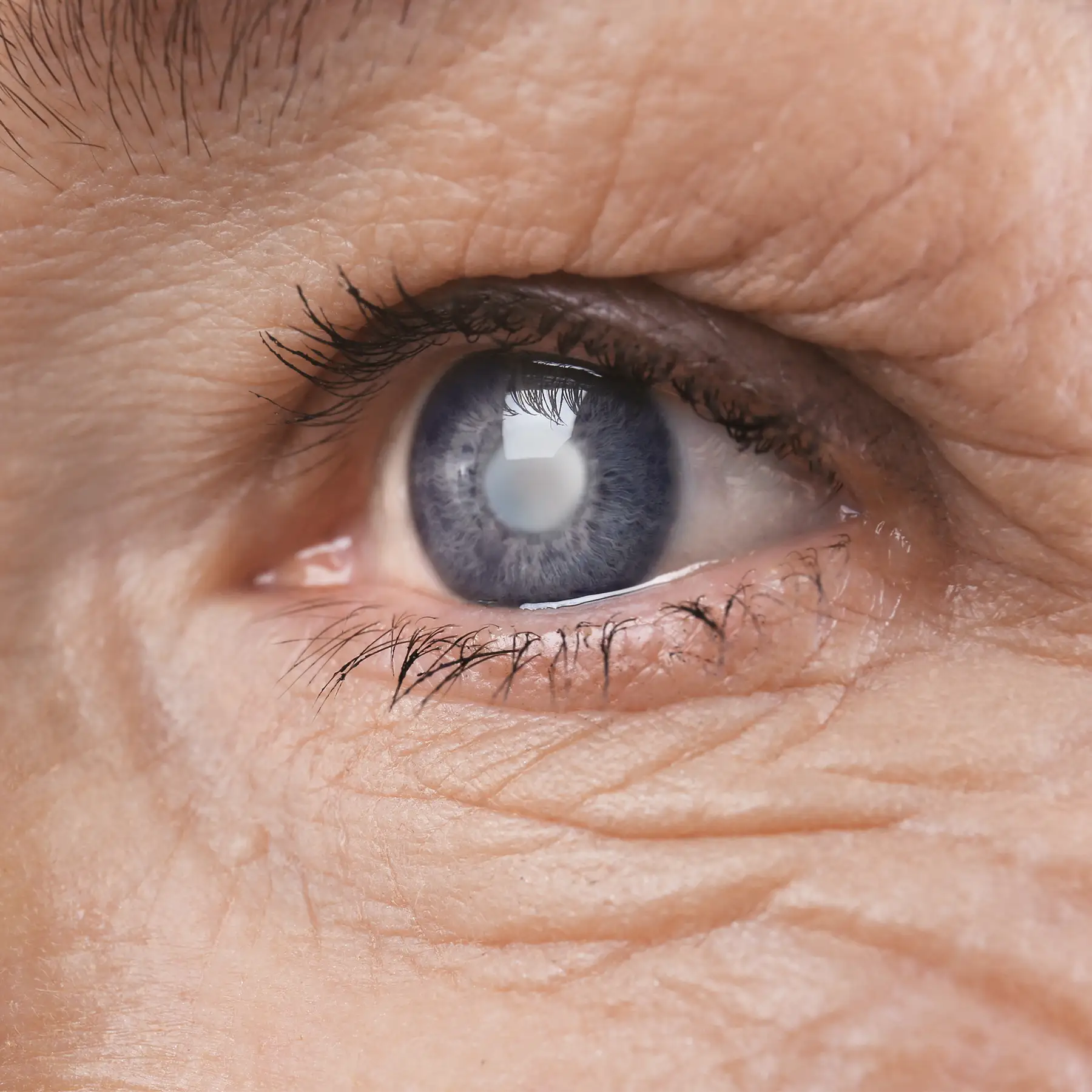 Laser Cataract Surgery - Modern Vision Centers